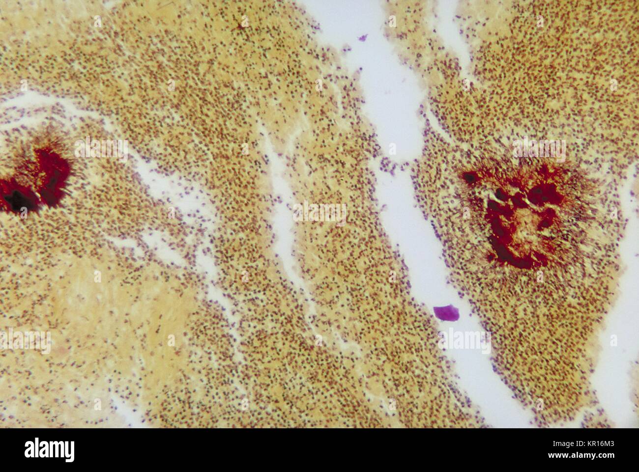 Actinomycosis hi-res stock photography and images - Alamy