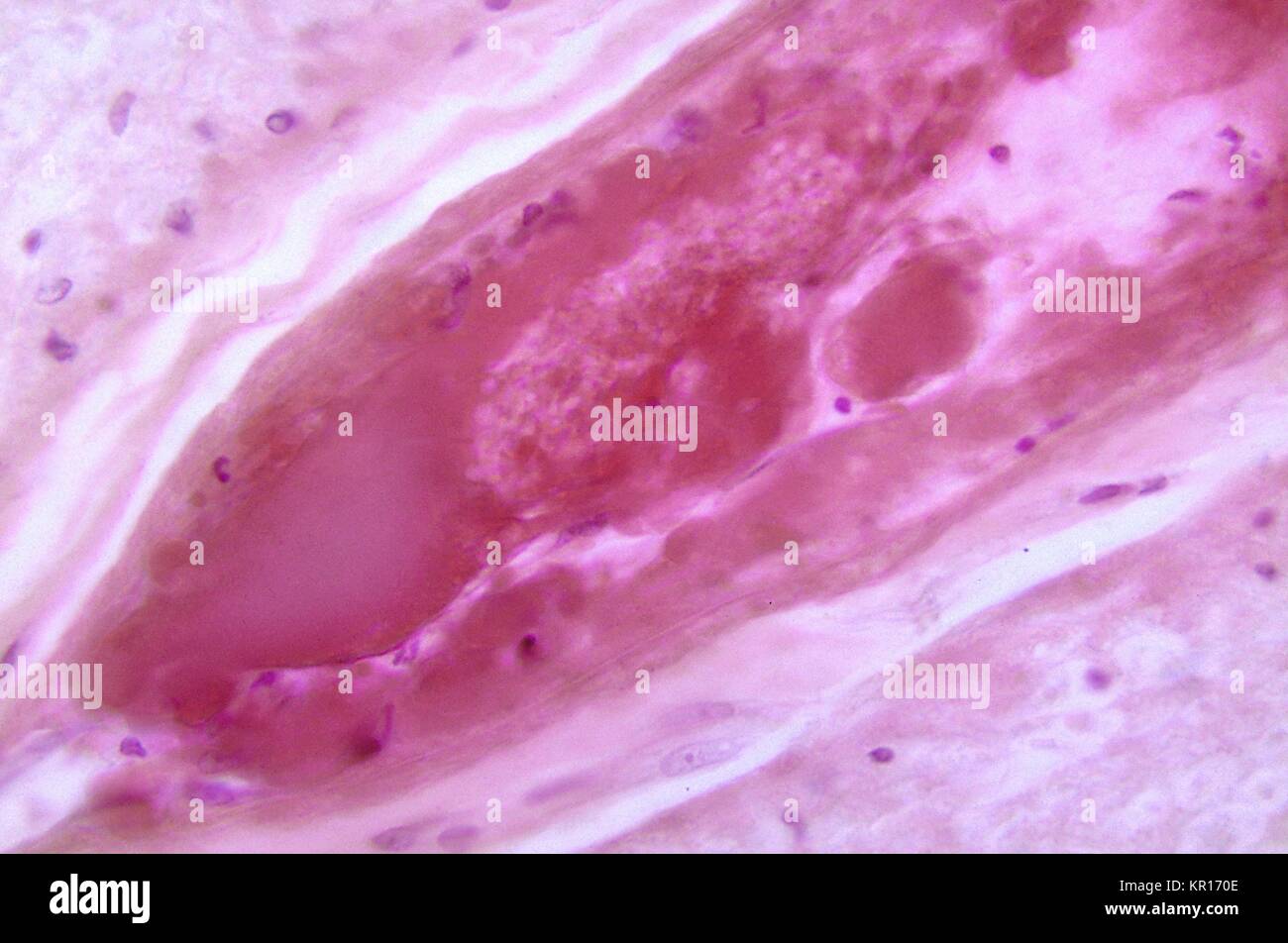 A photomicrograph of the lumbar spinal cord depicting an infarct due to ...