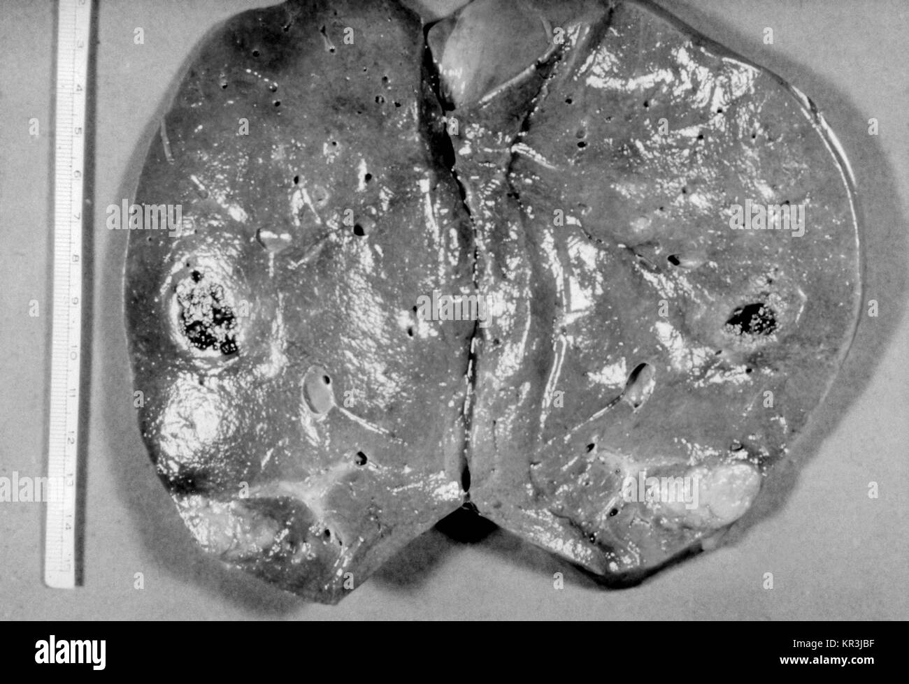 Tertiary syphilis hi-res stock photography and images - Alamy