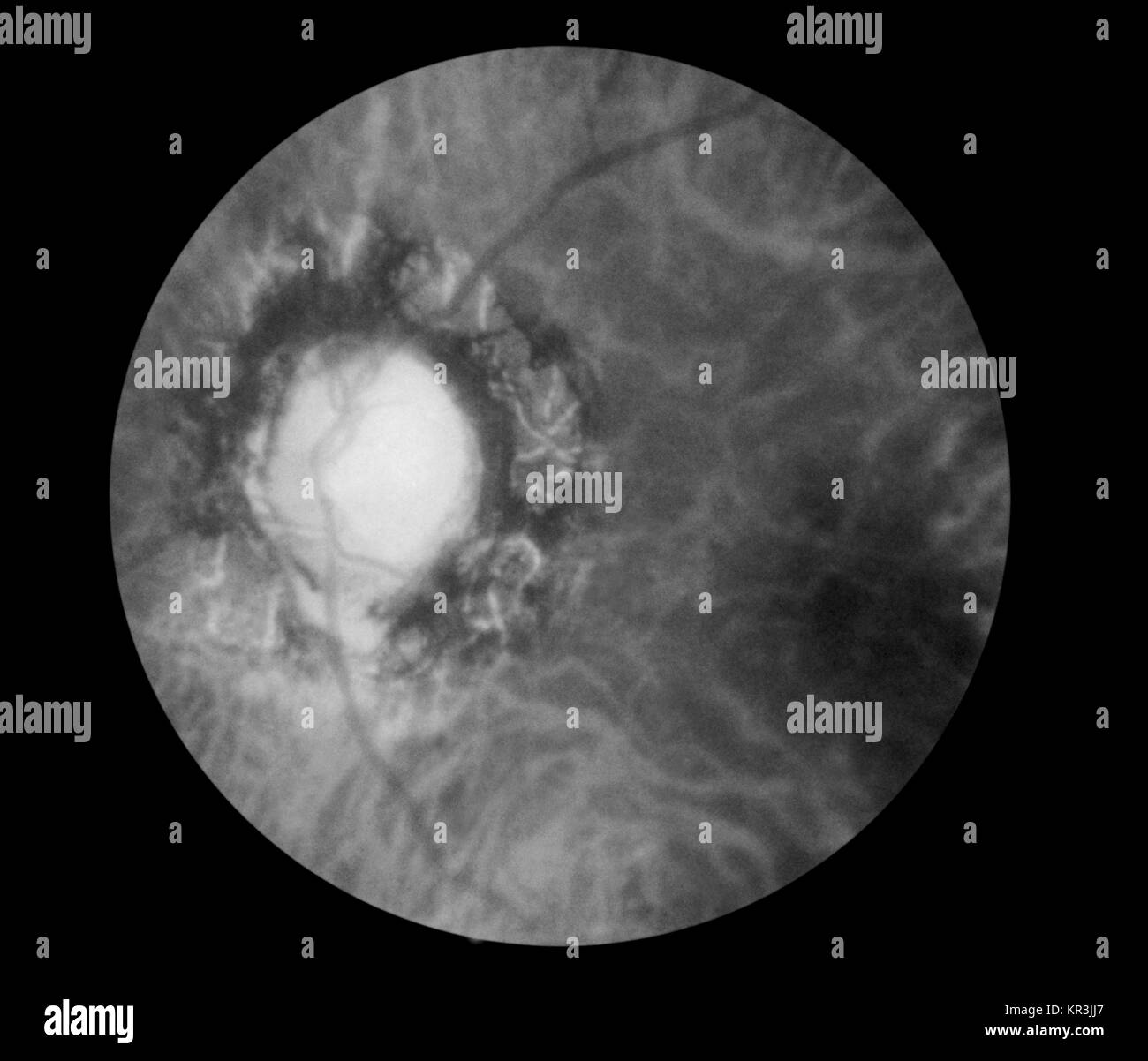 This funduscopic image reveals the effects of late neuro-ocular ...