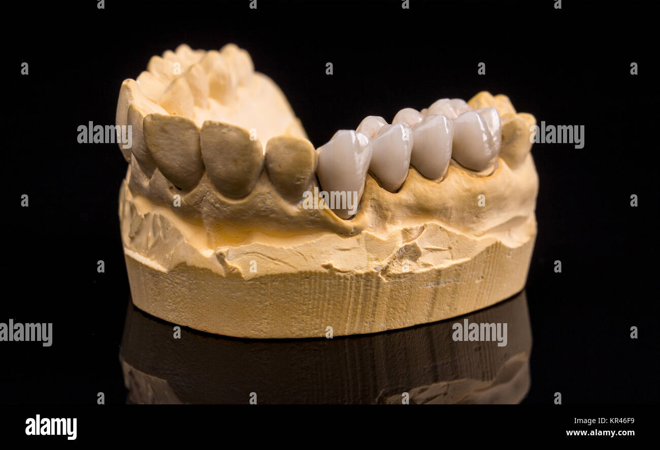 Porcelain false teeth High Resolution Stock Photography and Images - Alamy