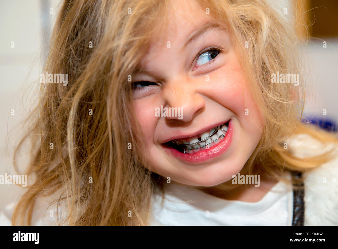 little funny girl with retainer Stock Photo - Alamy