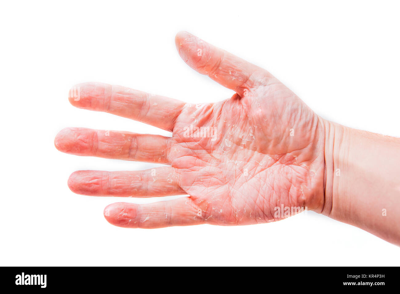 The problem with many people - eczema on hand. Isolated background ...