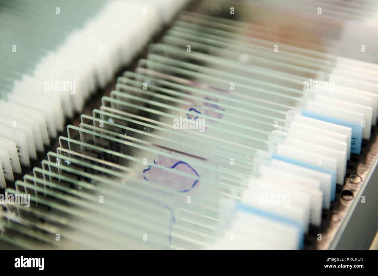 Racks hold large numbers of microscope slides containing patient biopsy ...