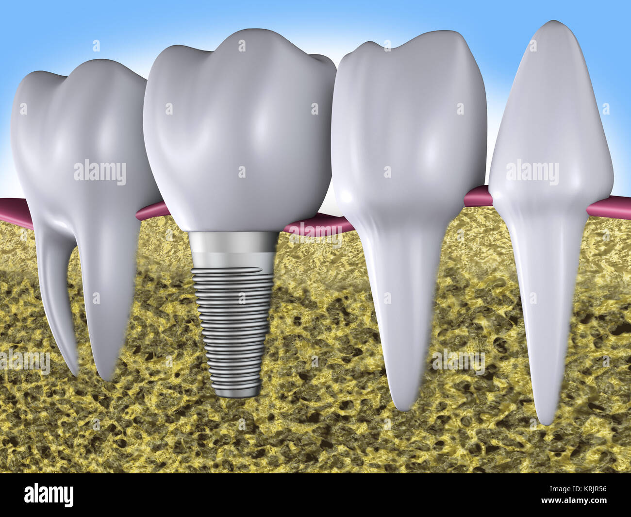 Teeth implantation hi-res stock photography and images - Alamy