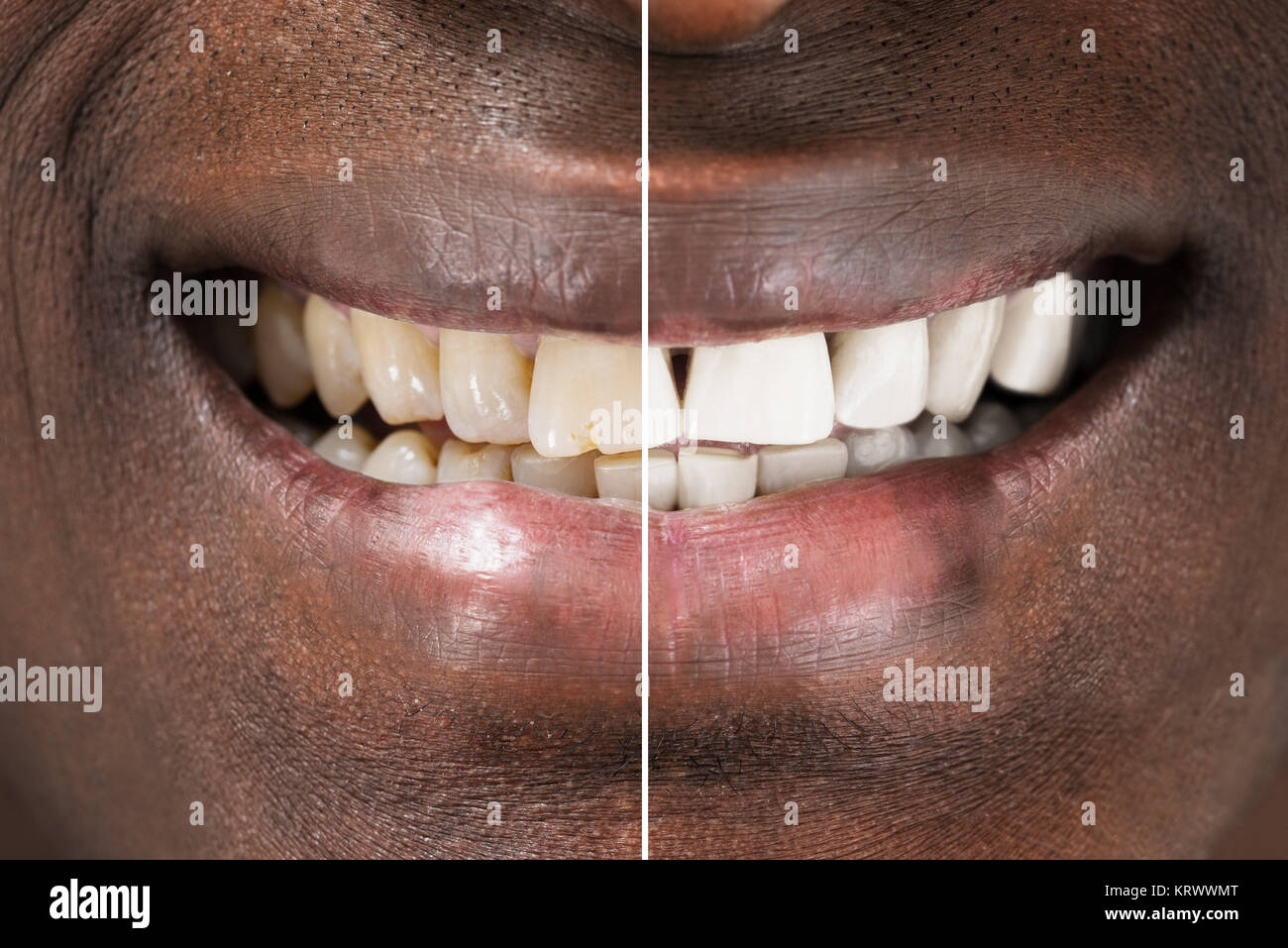 Man Teeth Before And After Whitening Stock Photo - Alamy