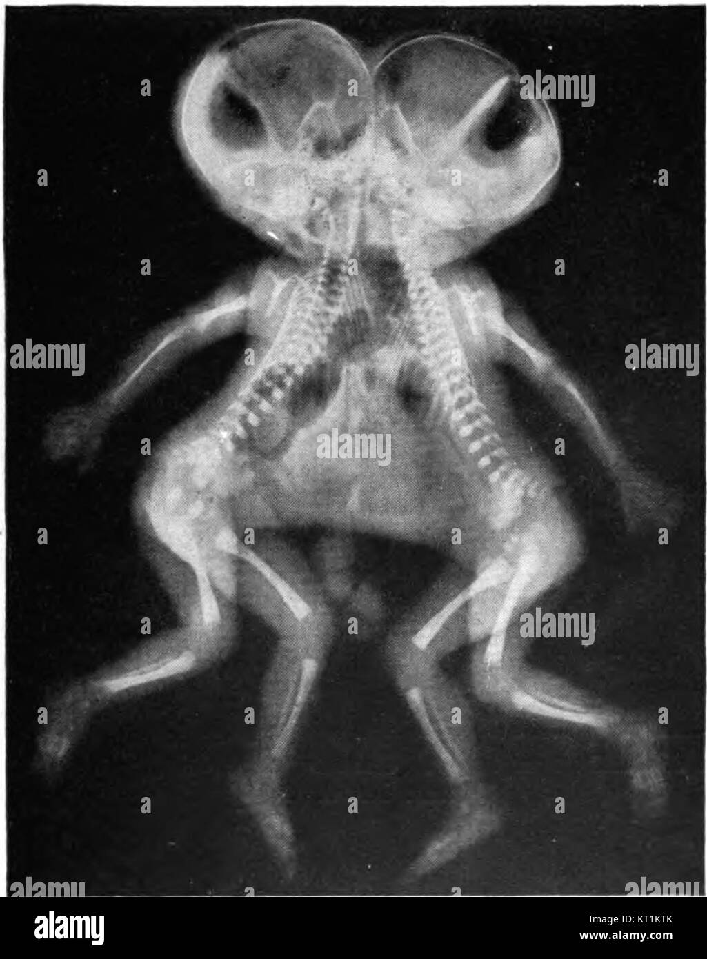 The conjoined X-ray is a medical imaging technique used to analyze the ...