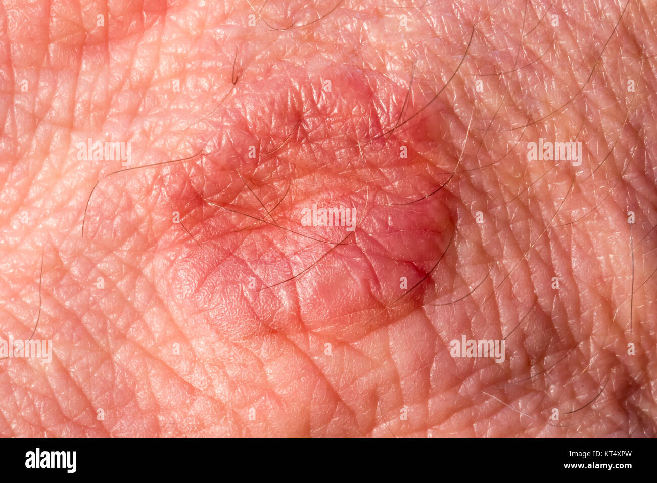 Exanthema disease hi-res stock photography and images - Alamy