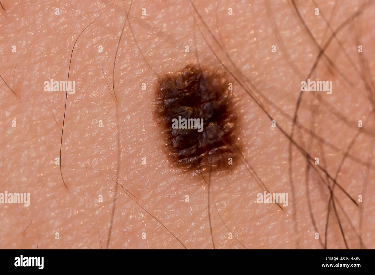 Skin lesions hi-res stock photography and images - Alamy