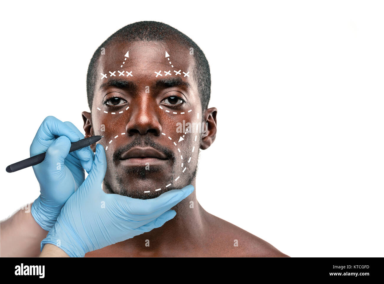 Man face surgery marks hi-res stock photography and images - Alamy