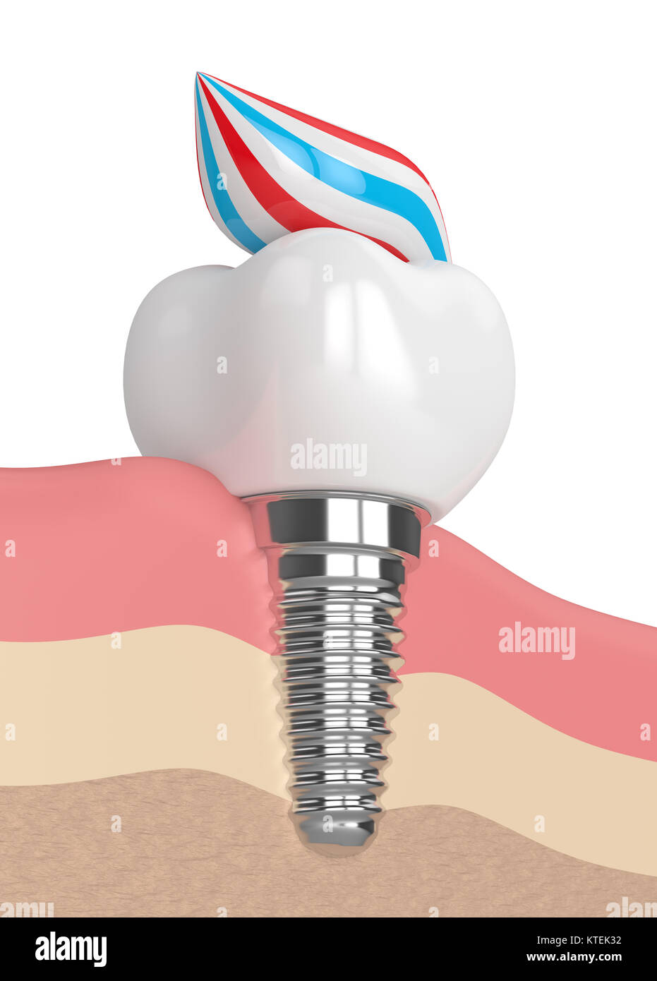 3d render of dental implant in gums with toothpaste Stock Photo - Alamy
