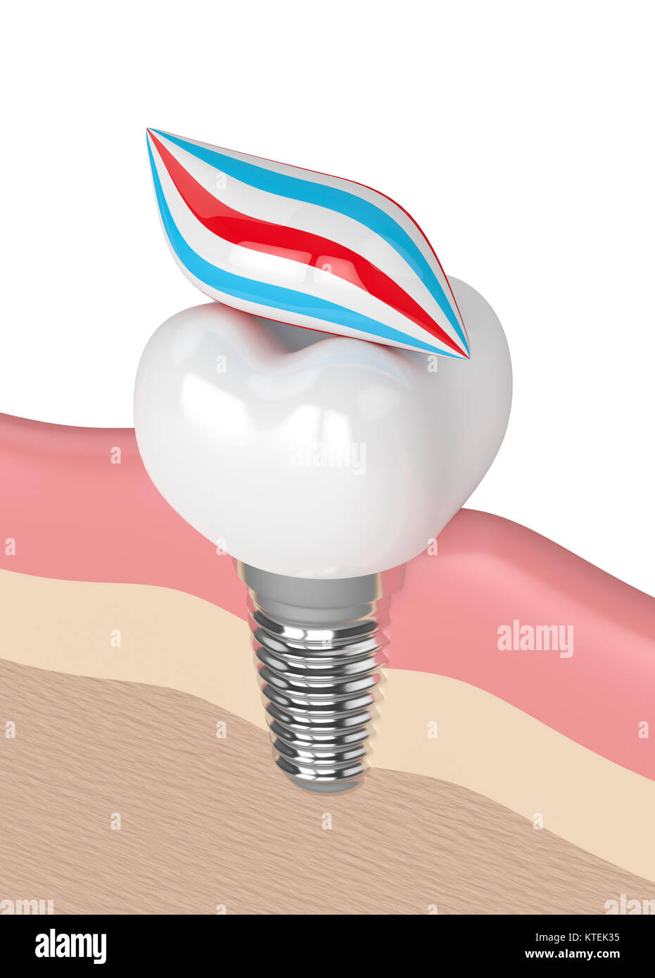 3d render of dental implant in gums with toothpaste Stock Photo - Alamy