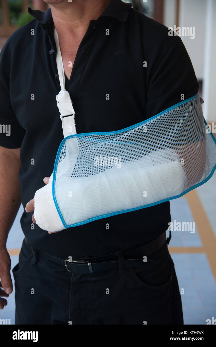 Man with a plaster because broken arm Stock Photo - Alamy