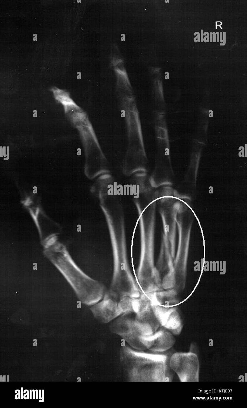 The Fourth metacarpal bone from a Moondyne remains specimen, a key ...