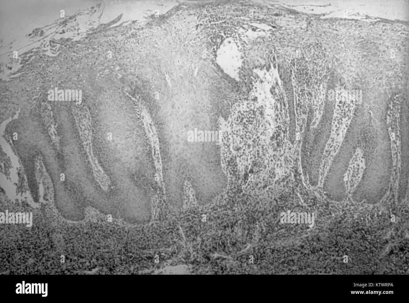 Syphilis Condyloma Latum
