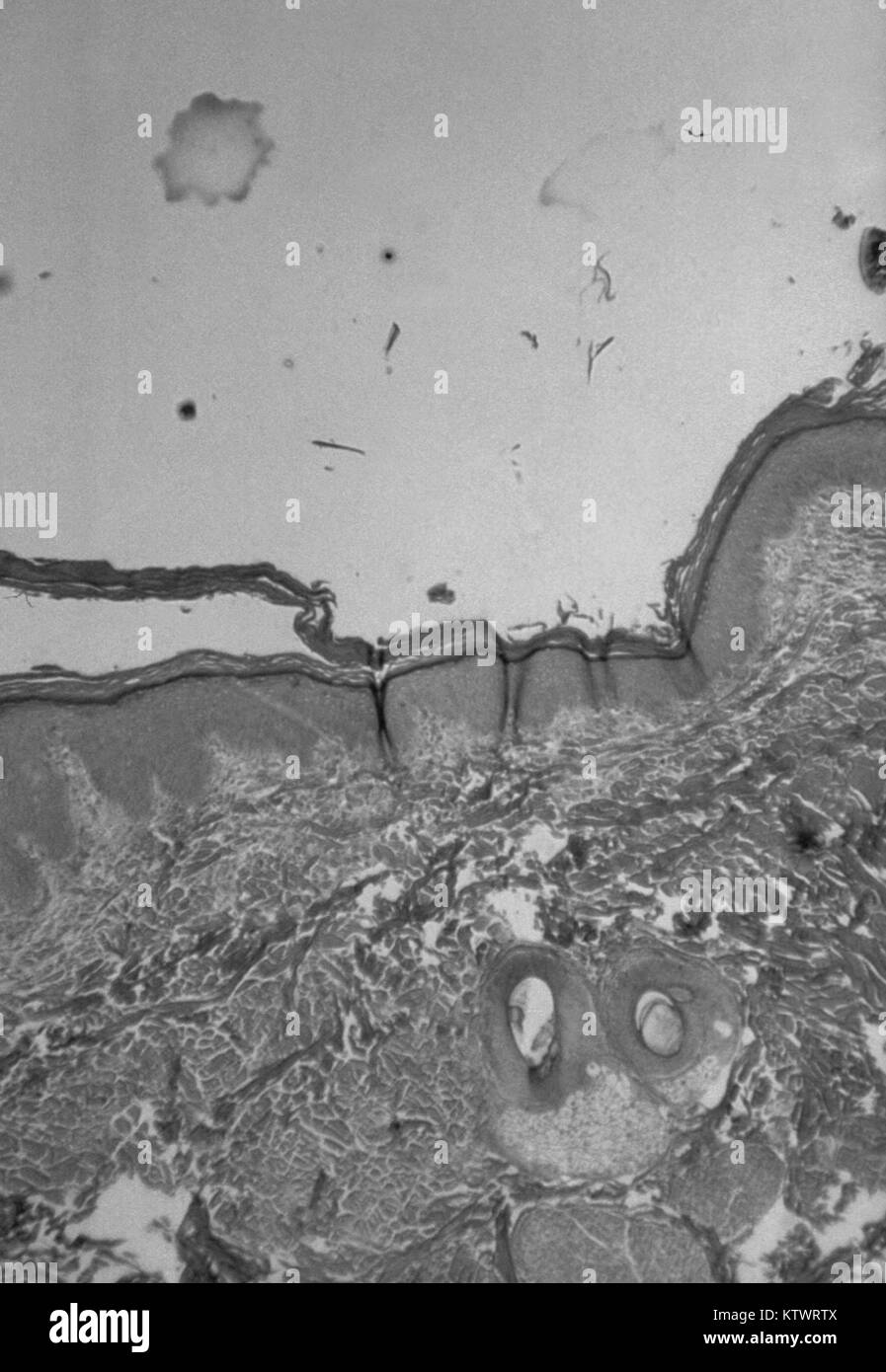 A photomicrographic study using HandE stain, of an early pinta, a skin ...