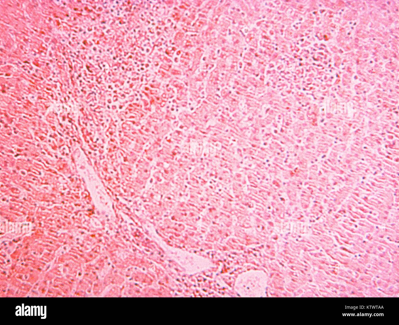 Interstitial edema hi-res stock photography and images - Alamy