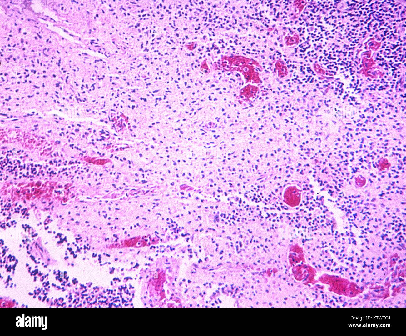 Histopathology of the gallbladder in a case of typhoid fever ...