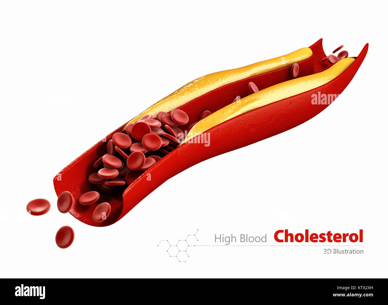 Cholesterol plaque in artery, 3d illustration. isolated white Stock ...