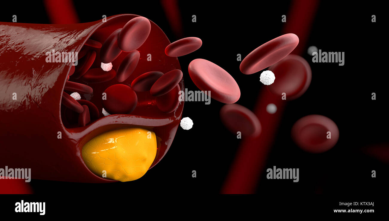 Blocked blood vessel, artery with cholesterol buildup realistic 3D ...
