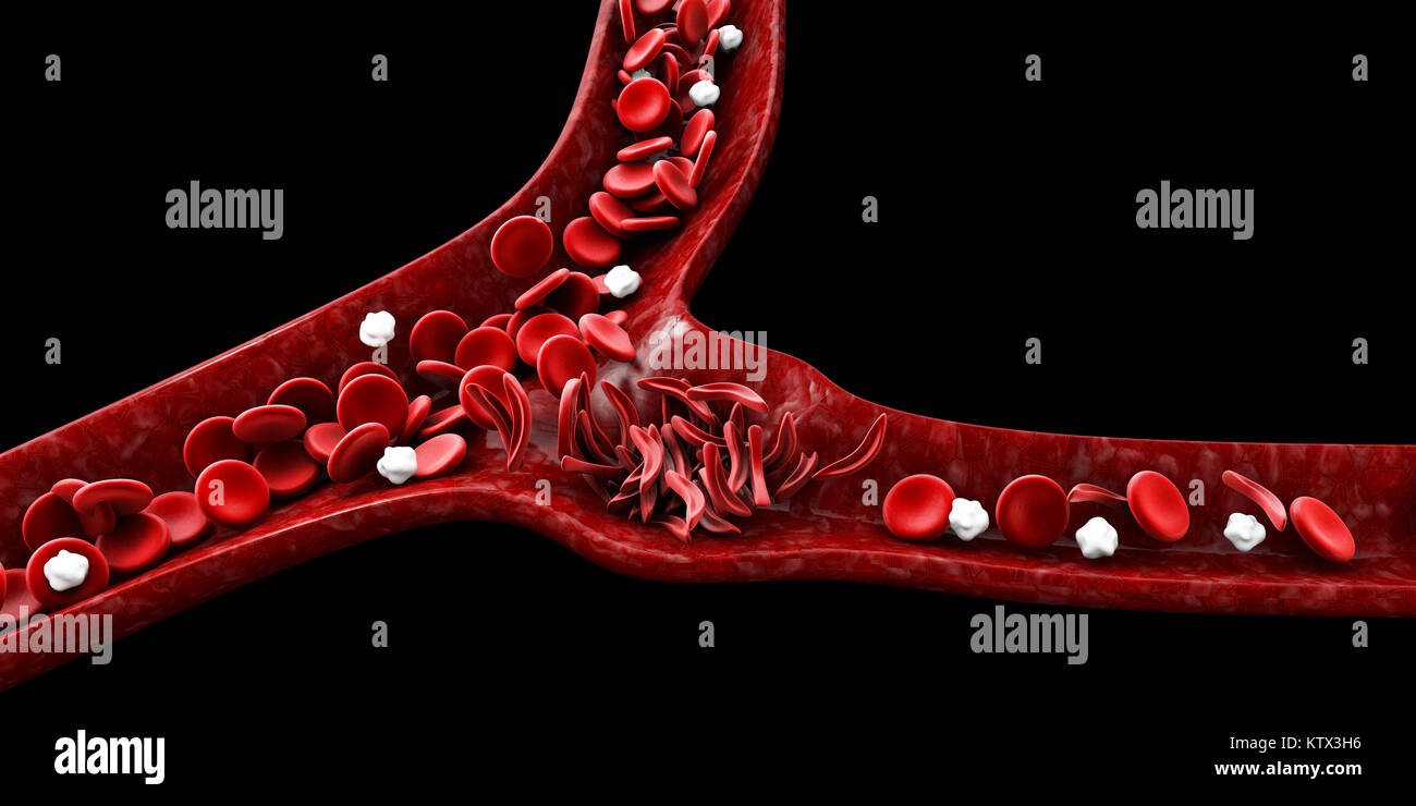 Sickle cell anemia, 3D illustration showing blood vessel with normal ...