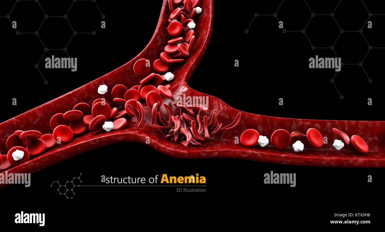 Sickle cell anemia, 3D illustration showing blood vessel with normal ...