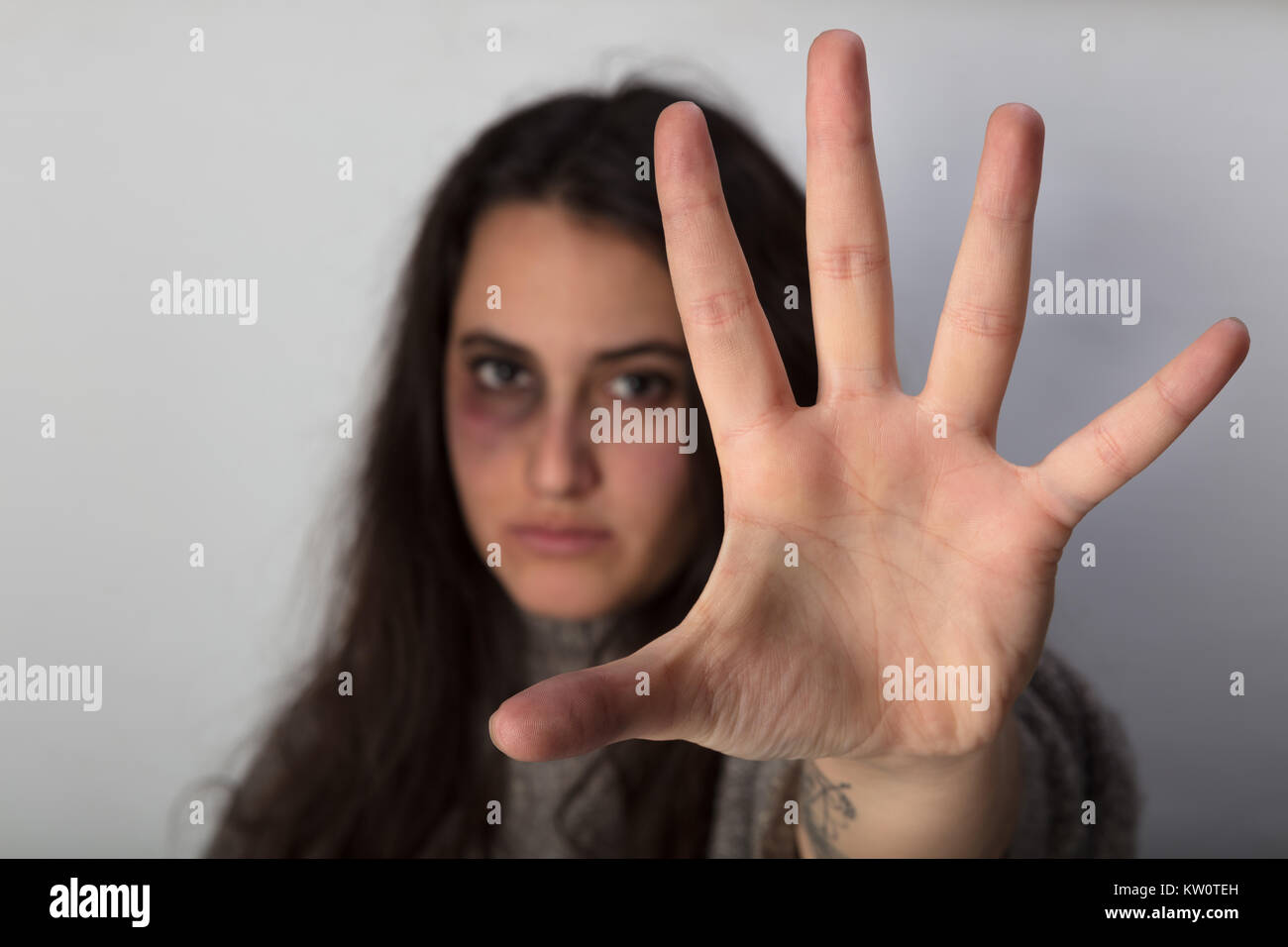 Child abuse bruise hi-res stock photography and images - Alamy