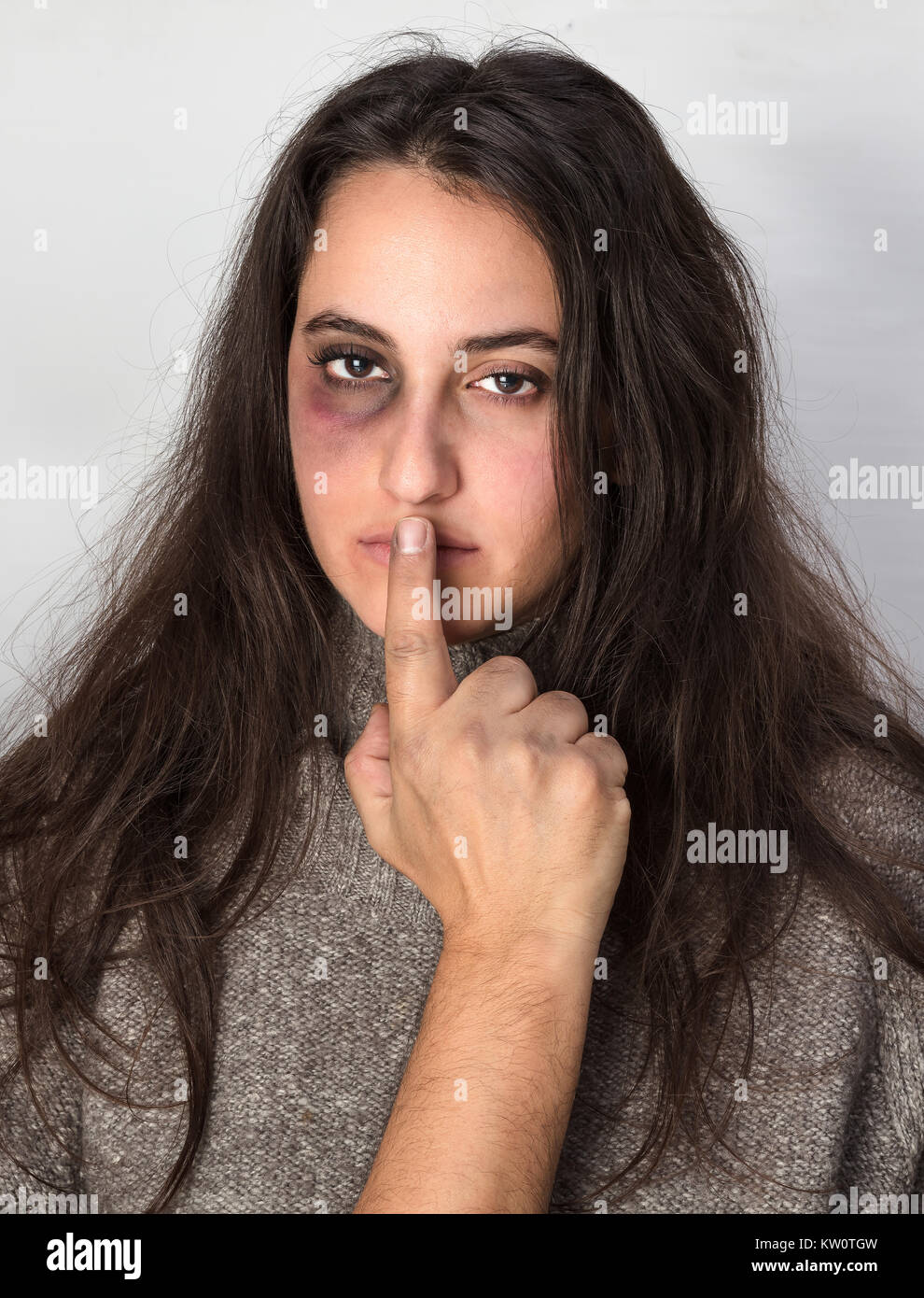 Severe bruise hi-res stock photography and images - Alamy