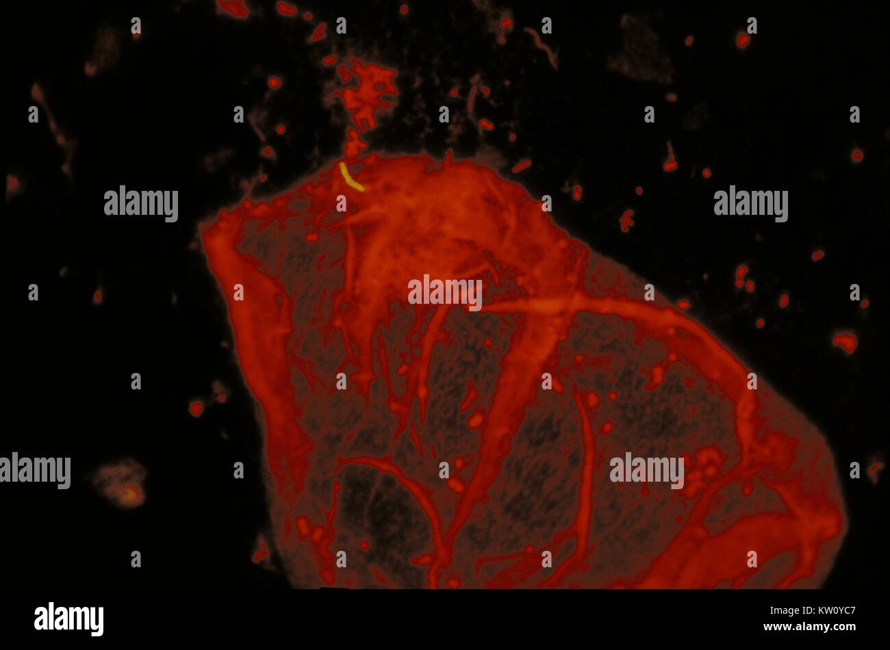 Mycobacterium tuberculosis in a sputum smear is stained using ...