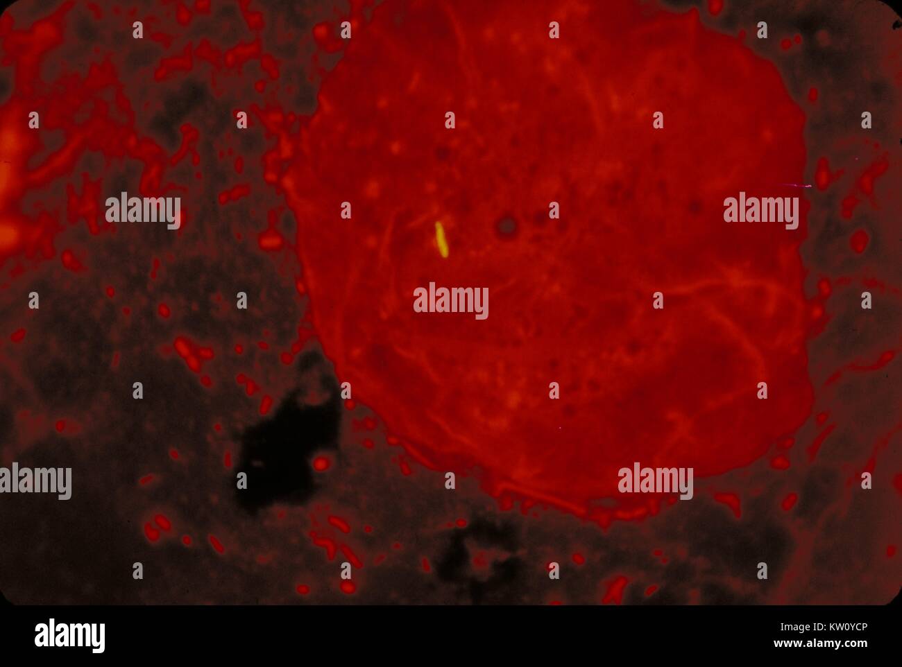 Mycobacterium tuberculosis in a sputum smear is stained using fluorescent auramine with acridine ...