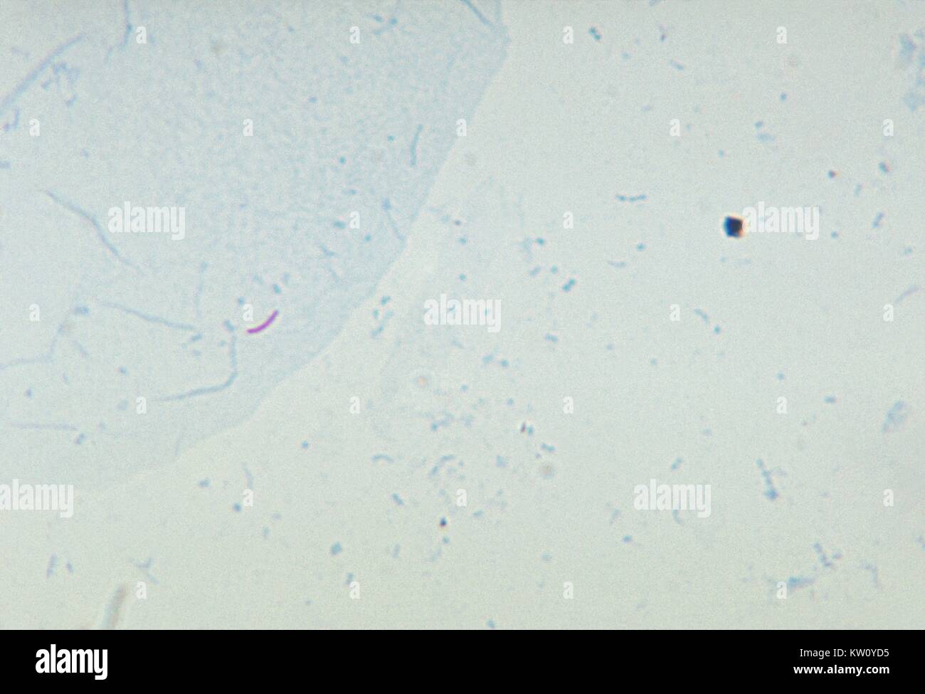 A photomicrograph of Mycobacterium tuberculosis in a sputum smear ...