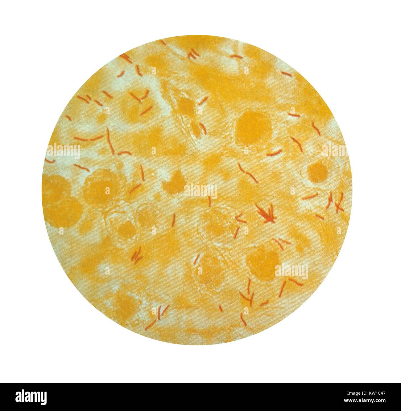 This illustration depicts a photomicrographic view of a sputum sample ...