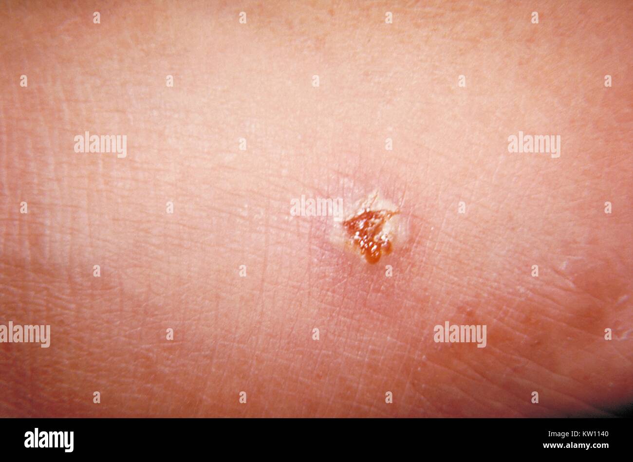 Auto inoculation reaction hi-res stock photography and images - Alamy
