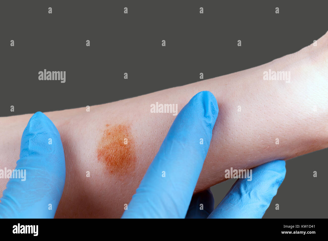 the doctor spends examining an allergic rash of patient Stock Photo - Alamy