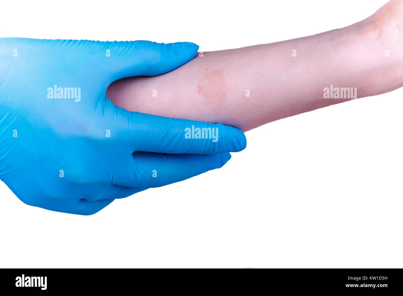 Benign skin rash hi-res stock photography and images - Alamy