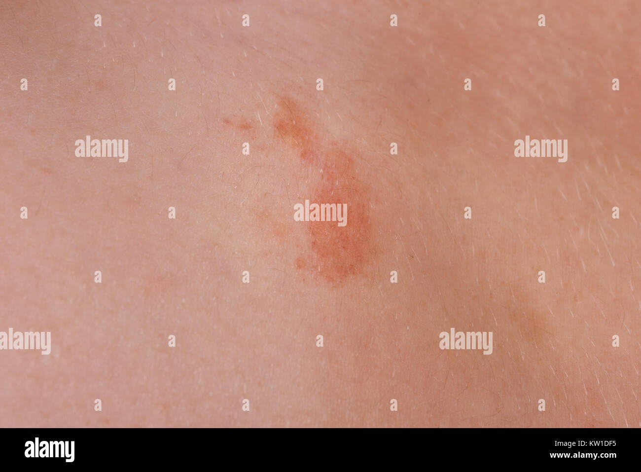 Red birthmark on face hi-res stock photography and images - Alamy