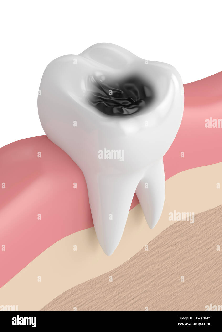 3d render of tooth with decay in gums over white Stock Photo - Alamy