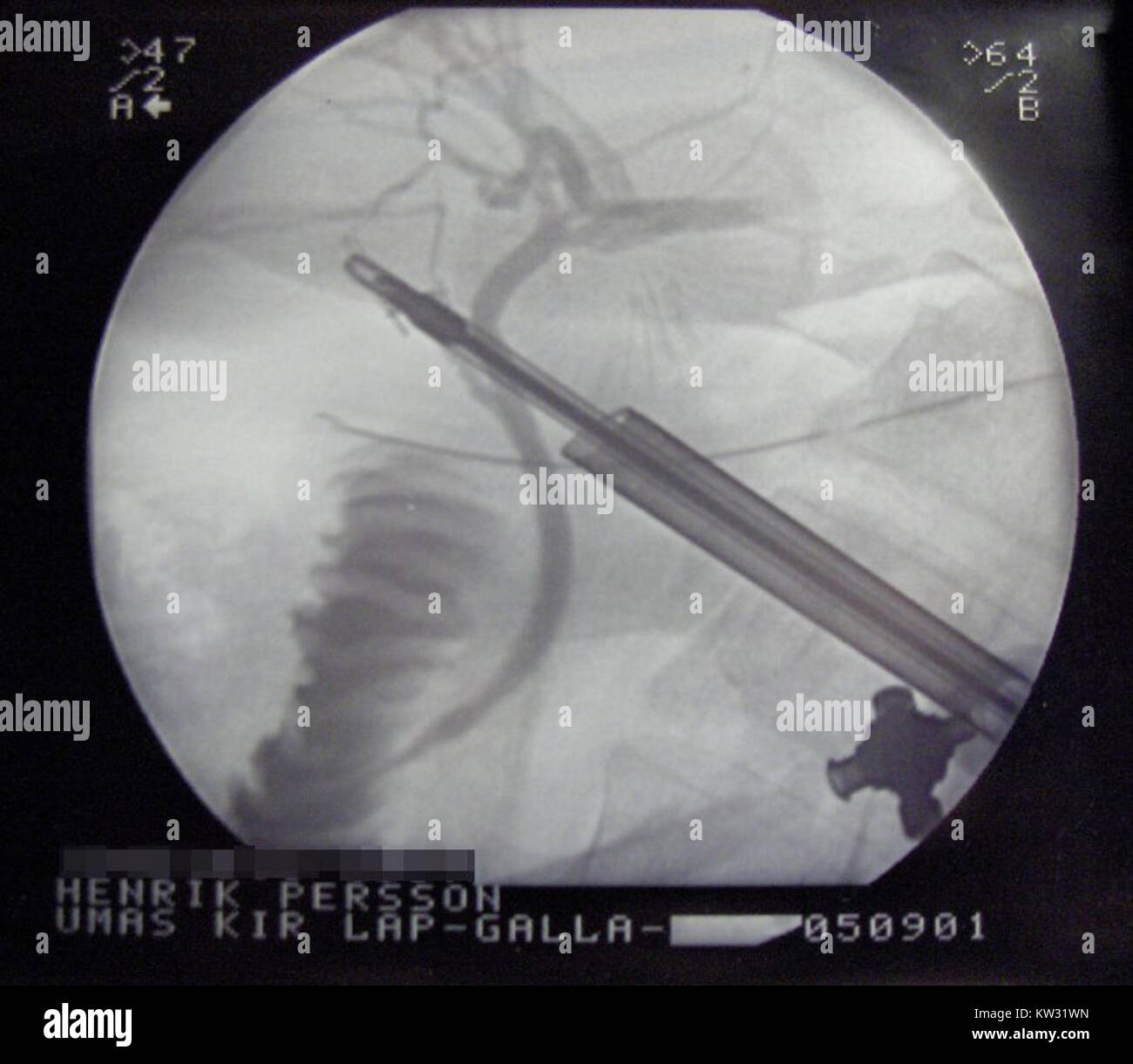 Laproscopy hi-res stock photography and images - Alamy