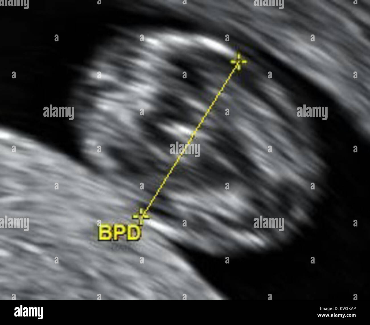 Biparietal hi-res stock photography and images - Alamy