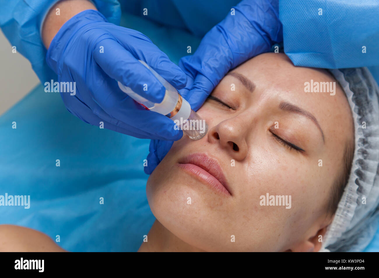 Cosmetic treatment by injection in the clinic. Use of a dermal injector ...