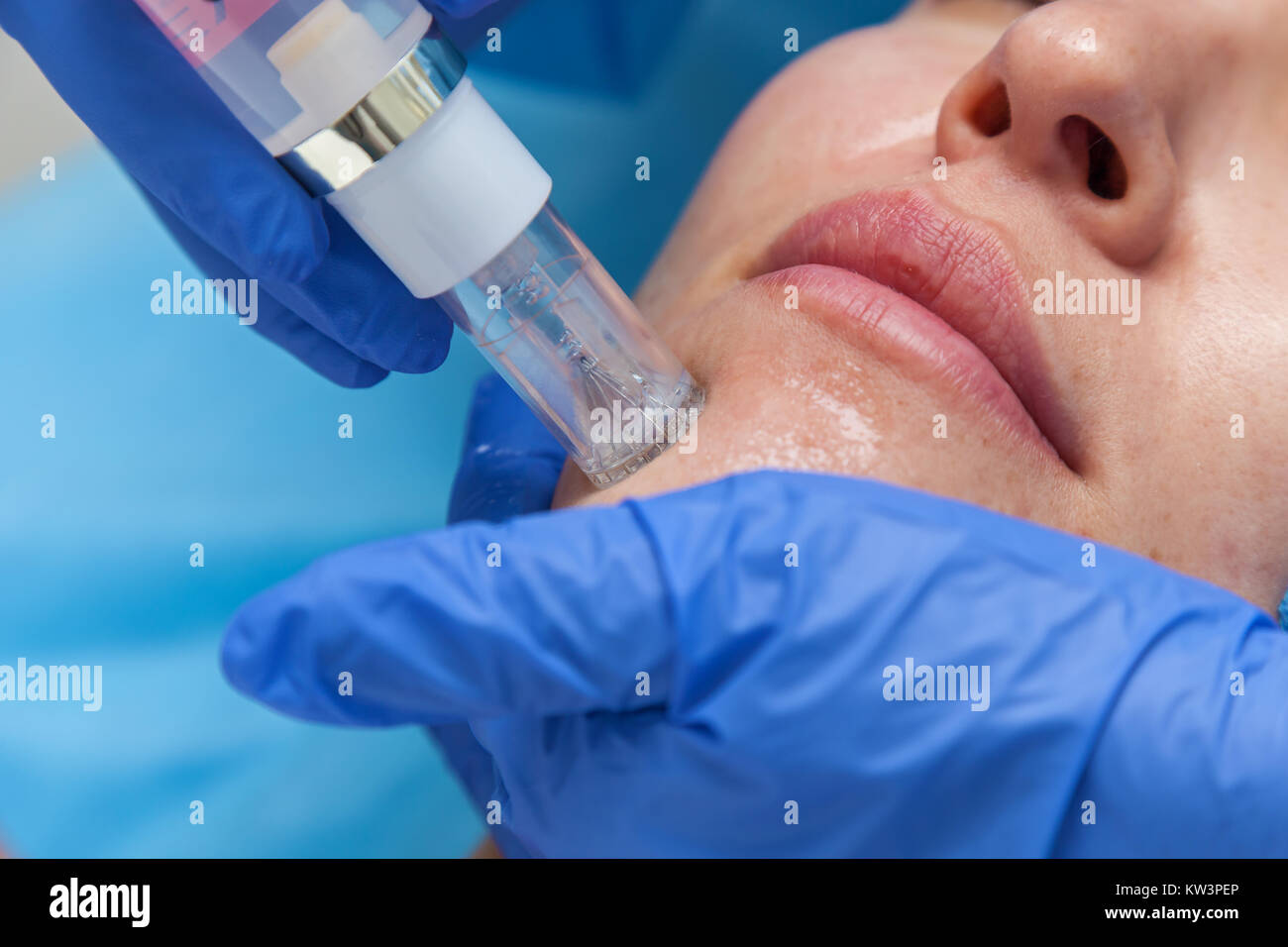 Cosmetic treatment by injection in the clinic. Use of a dermal injector ...