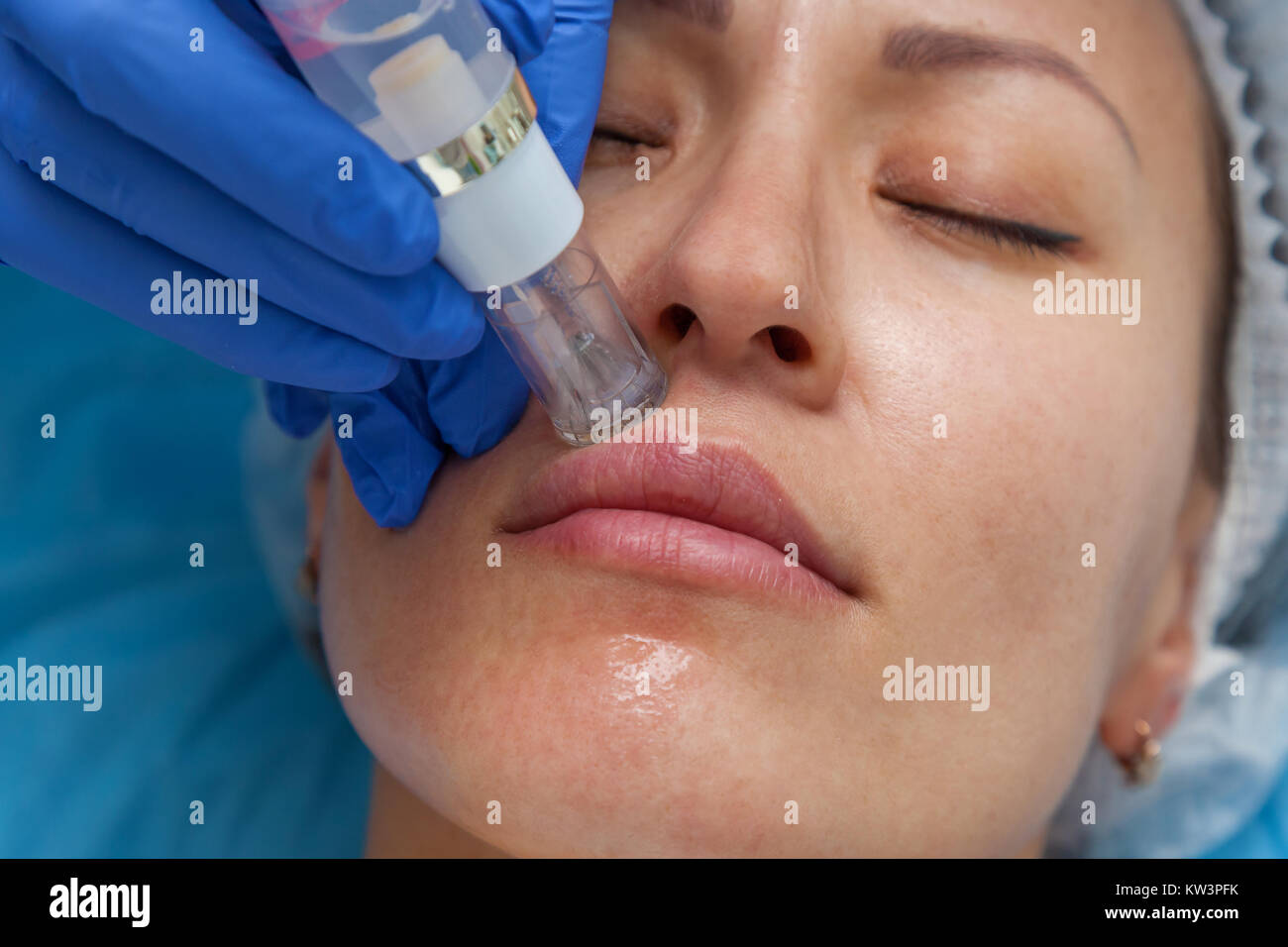 Cosmetic treatment by injection in the clinic. Use of a dermal injector ...