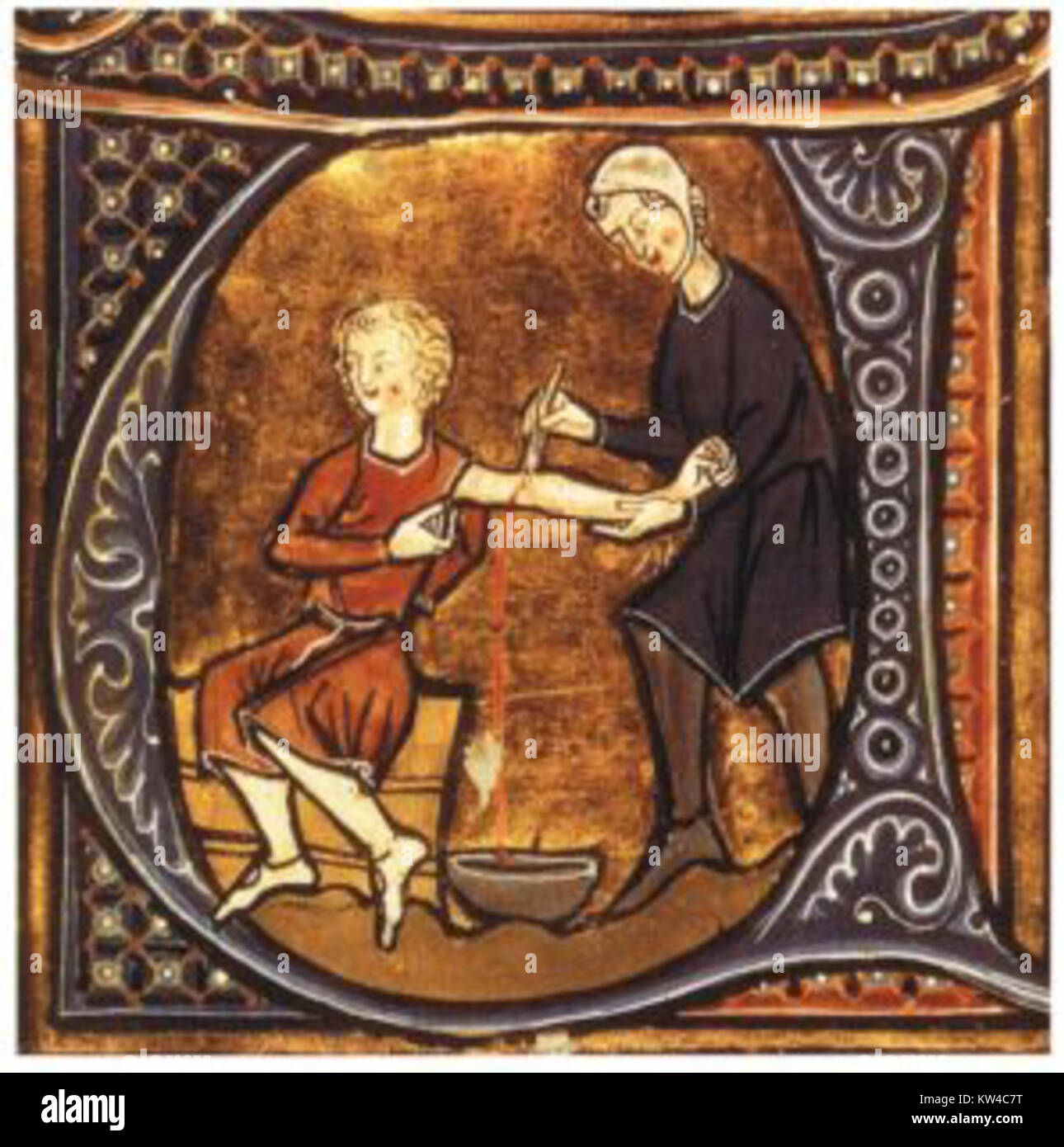 This image depicts the practice of bloodletting, a historical medical ...