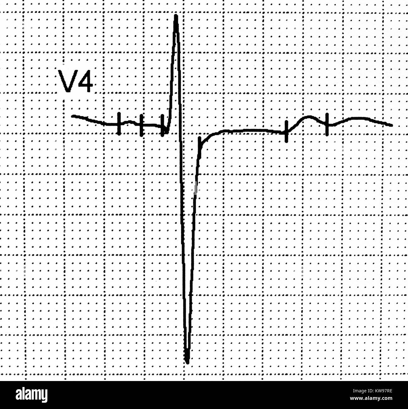 Electrocardiogram test that shows electrical activity of the heart ...