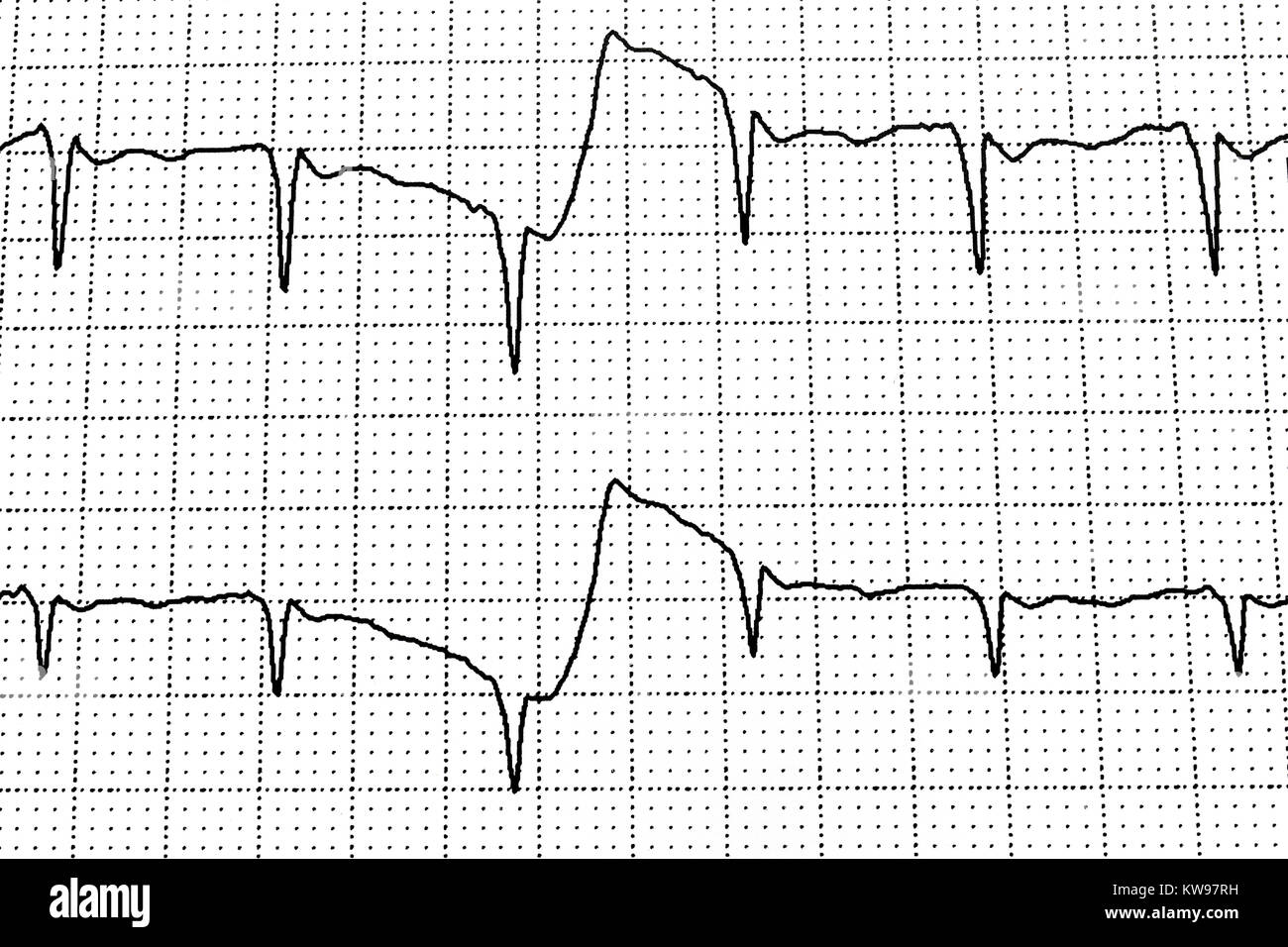 Electrocardiogram test that shows electrical activity of the heart ...