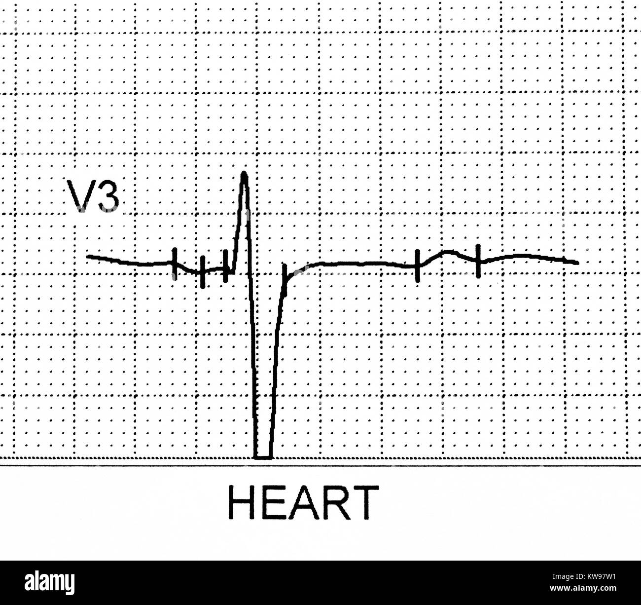 Electrocardiogram test that shows electrical activity of the heart ...