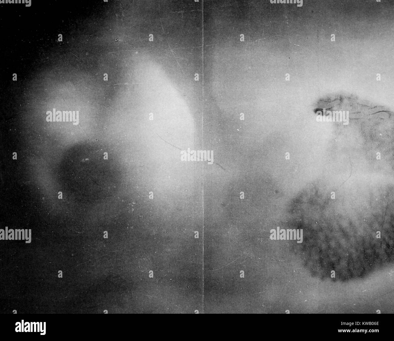 Early medical X Ray image showing uric acid calculus in 28 year old ...