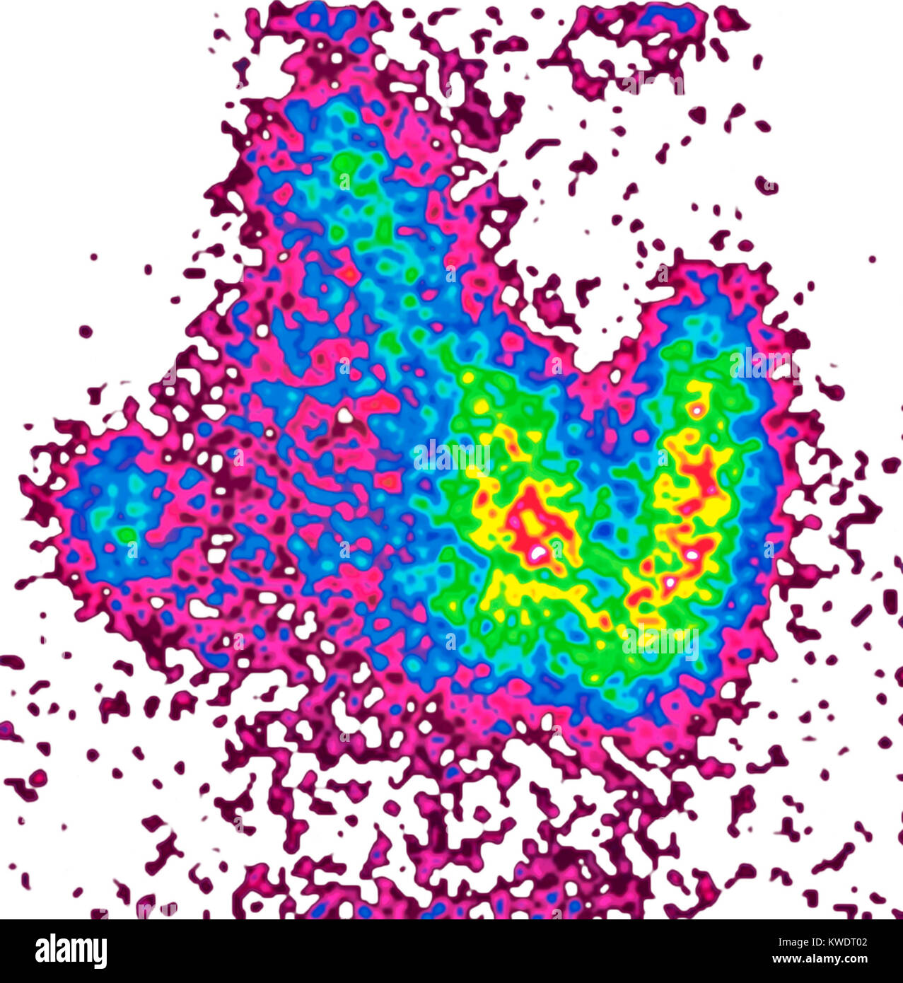 Thyroid scintigraphy of a woman. Follicular thyroid carcinoma before ...