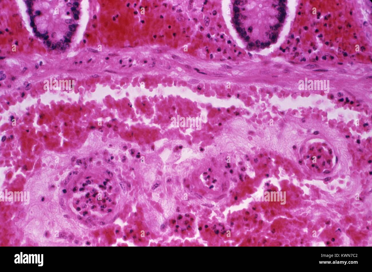 This micrograph reveals submucosal hemorrhage in the small intestine ...