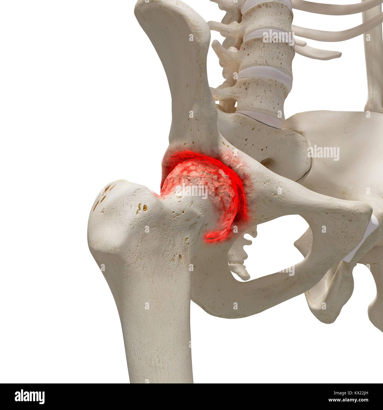 Arthritis of the hip hi-res stock photography and images - Alamy